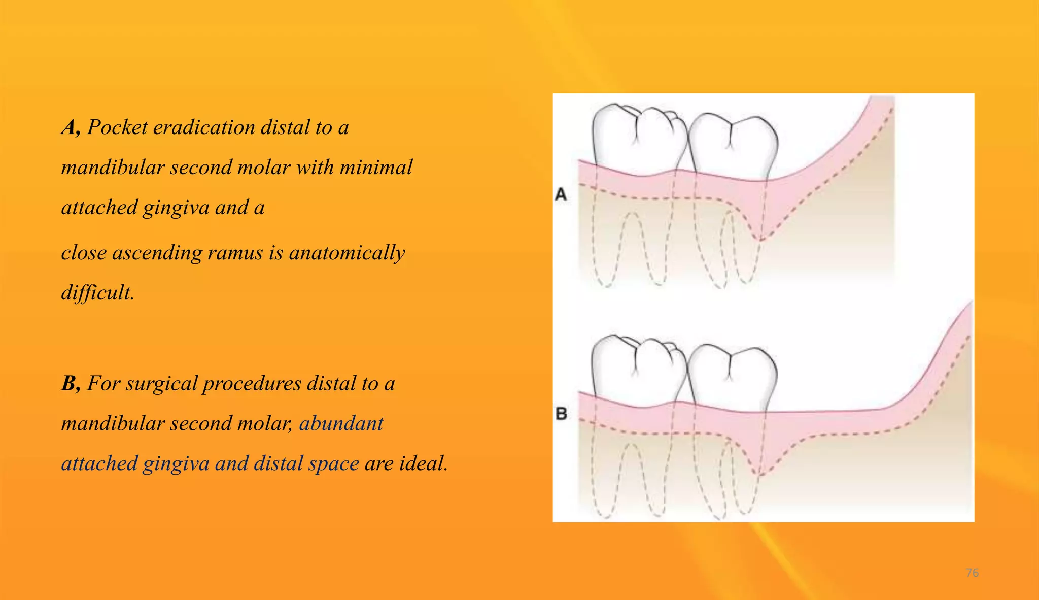 Periodontal flap surgery | PPTX