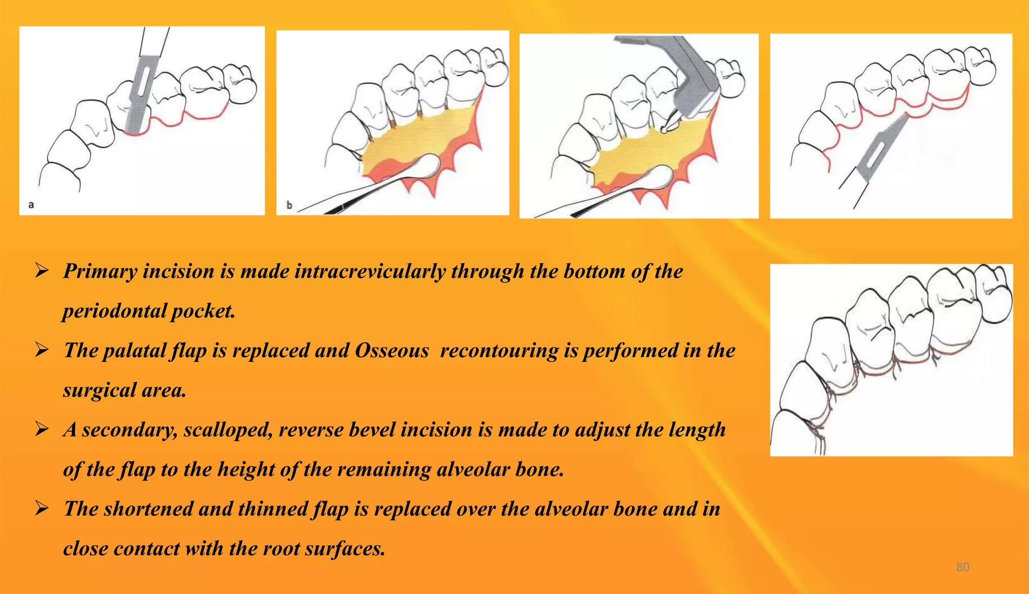Periodontal flap surgery | PPTX
