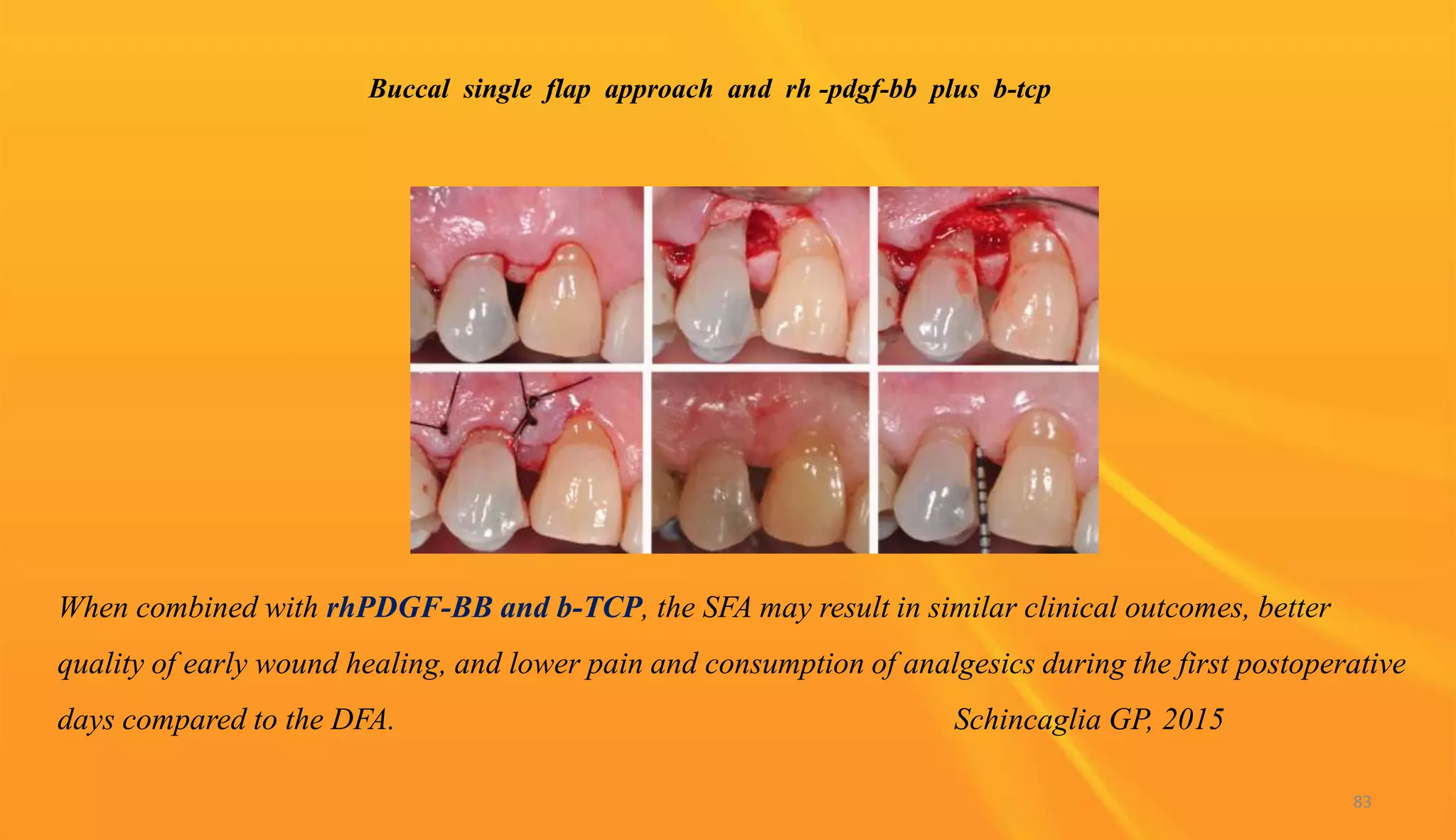 Periodontal flap surgery | PPTX