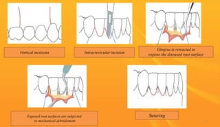 Periodontal flap surgery | PPTX