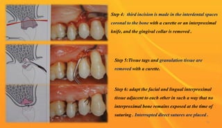 Periodontal flap surgery | PPTX