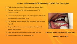 Periodontal flap surgery | PPTX