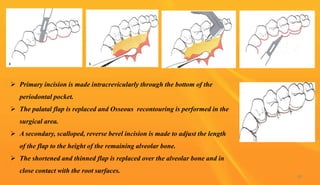 Periodontal flap surgery | PPTX