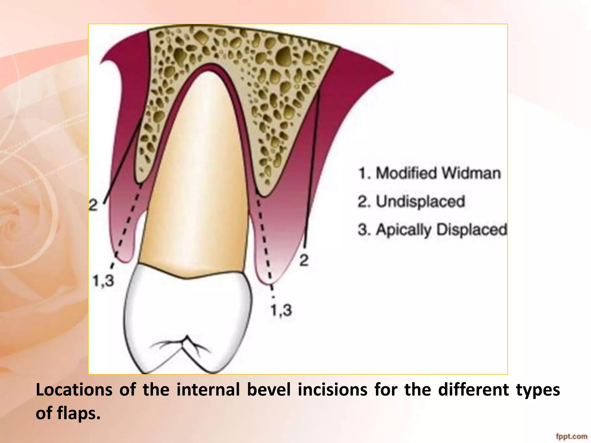 periodontal flap surgery.pptx