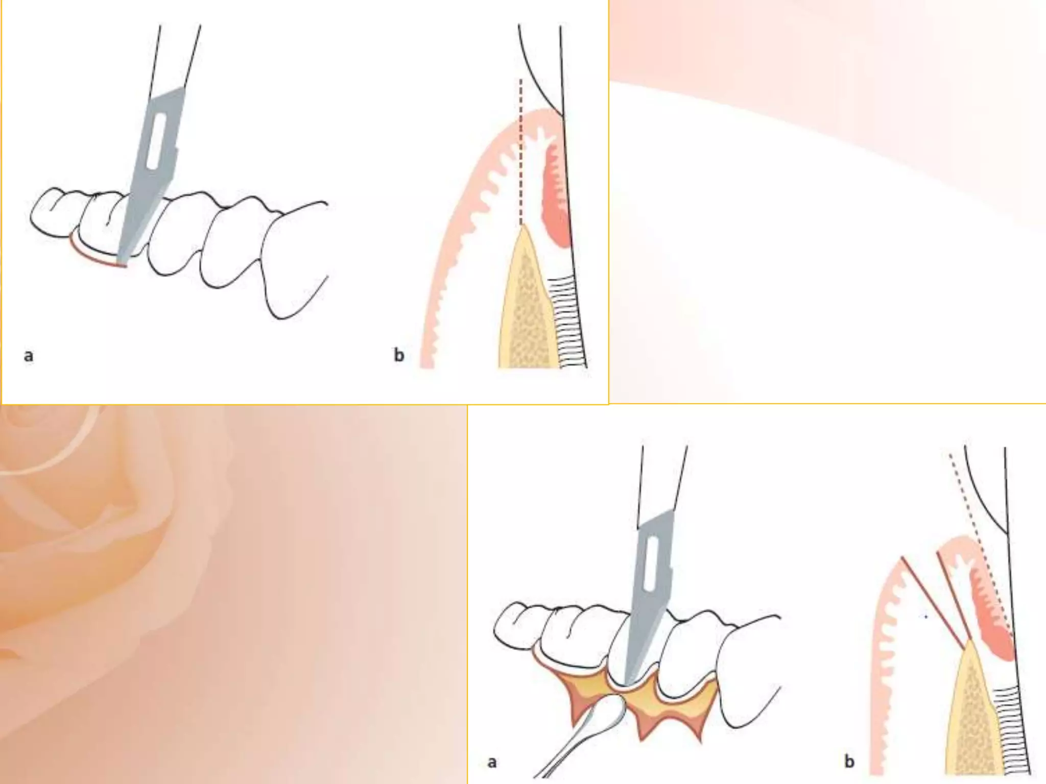periodontal flap surgery.pptx