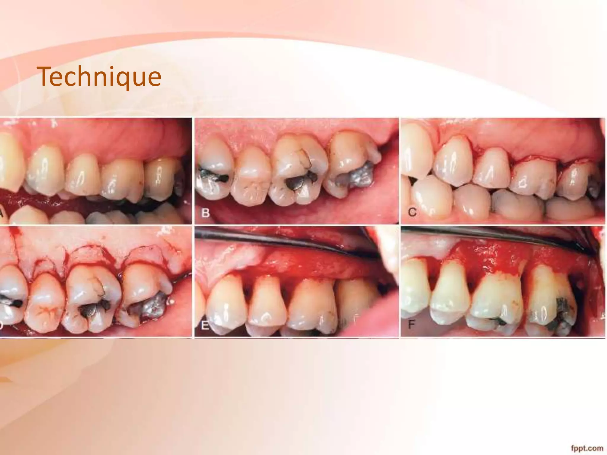 periodontal flap surgery.pptx