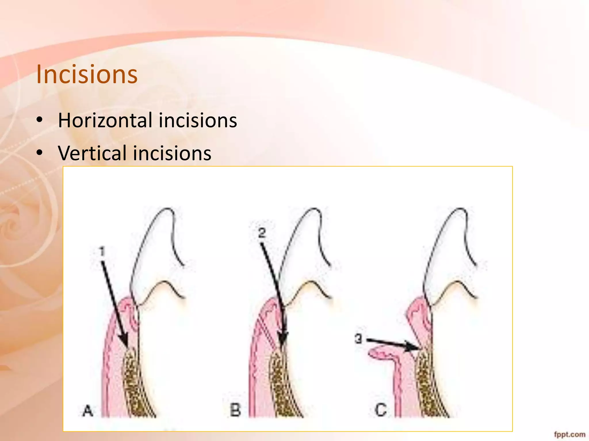 periodontal flap surgery.pptx