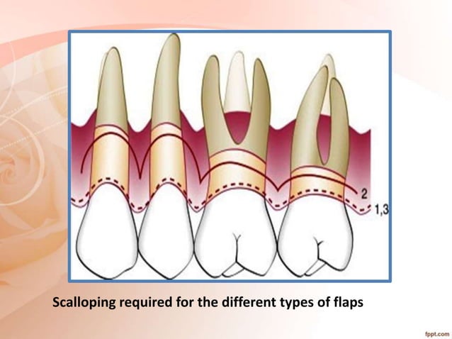 periodontal flap surgery.pptx | Oral care | Personal Care