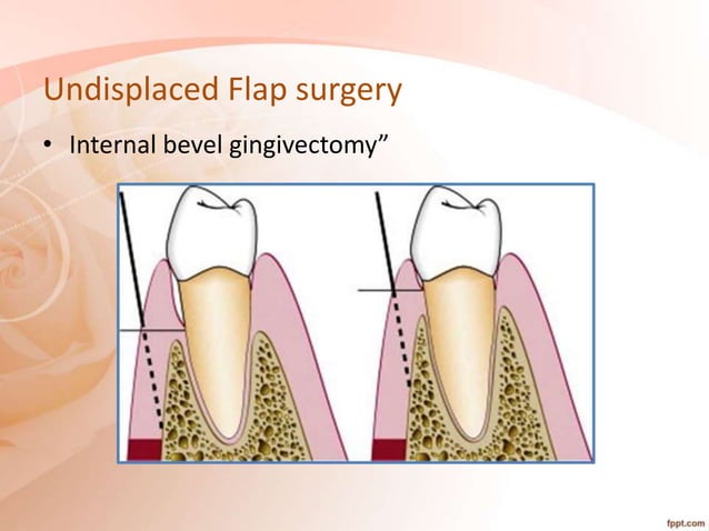 periodontal flap surgery.pptx | Oral care | Personal Care