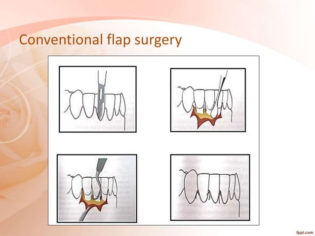 periodontal flap surgery.pptx | Oral care | Personal Care