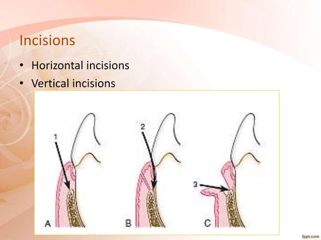 periodontal flap surgery.pptx | Oral care | Personal Care