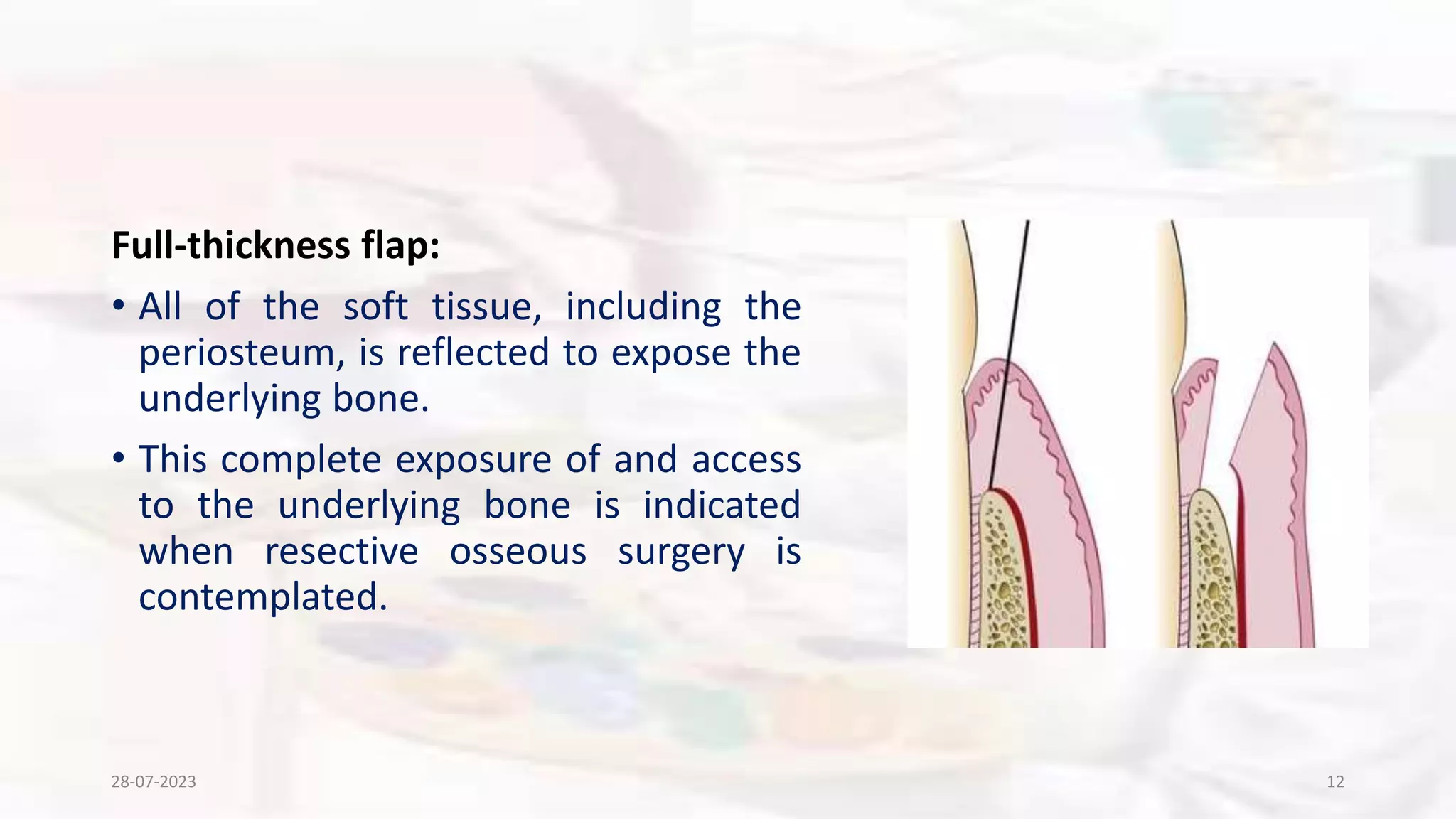periodontal flap surgery | PPTX