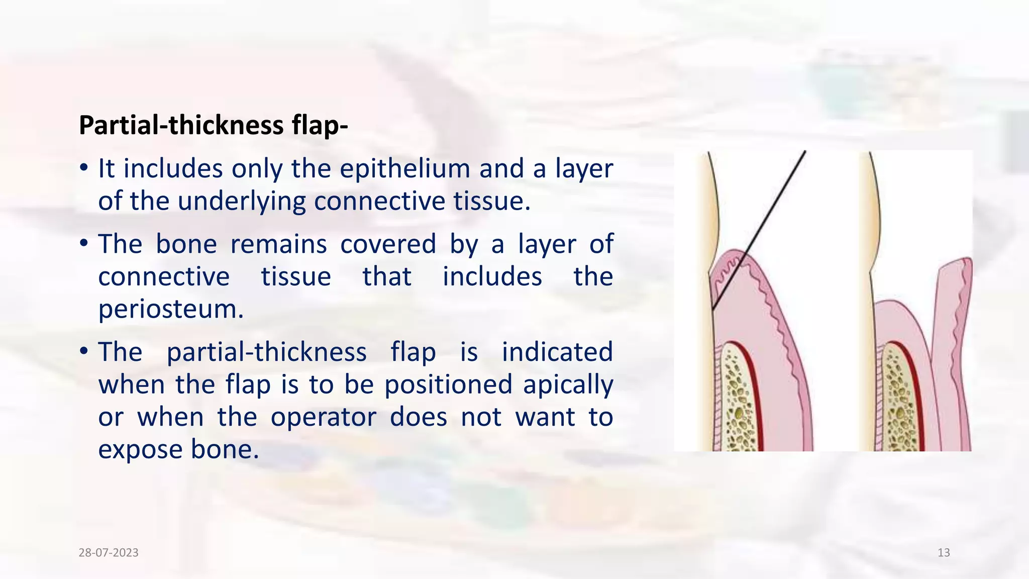 periodontal flap surgery | PPTX