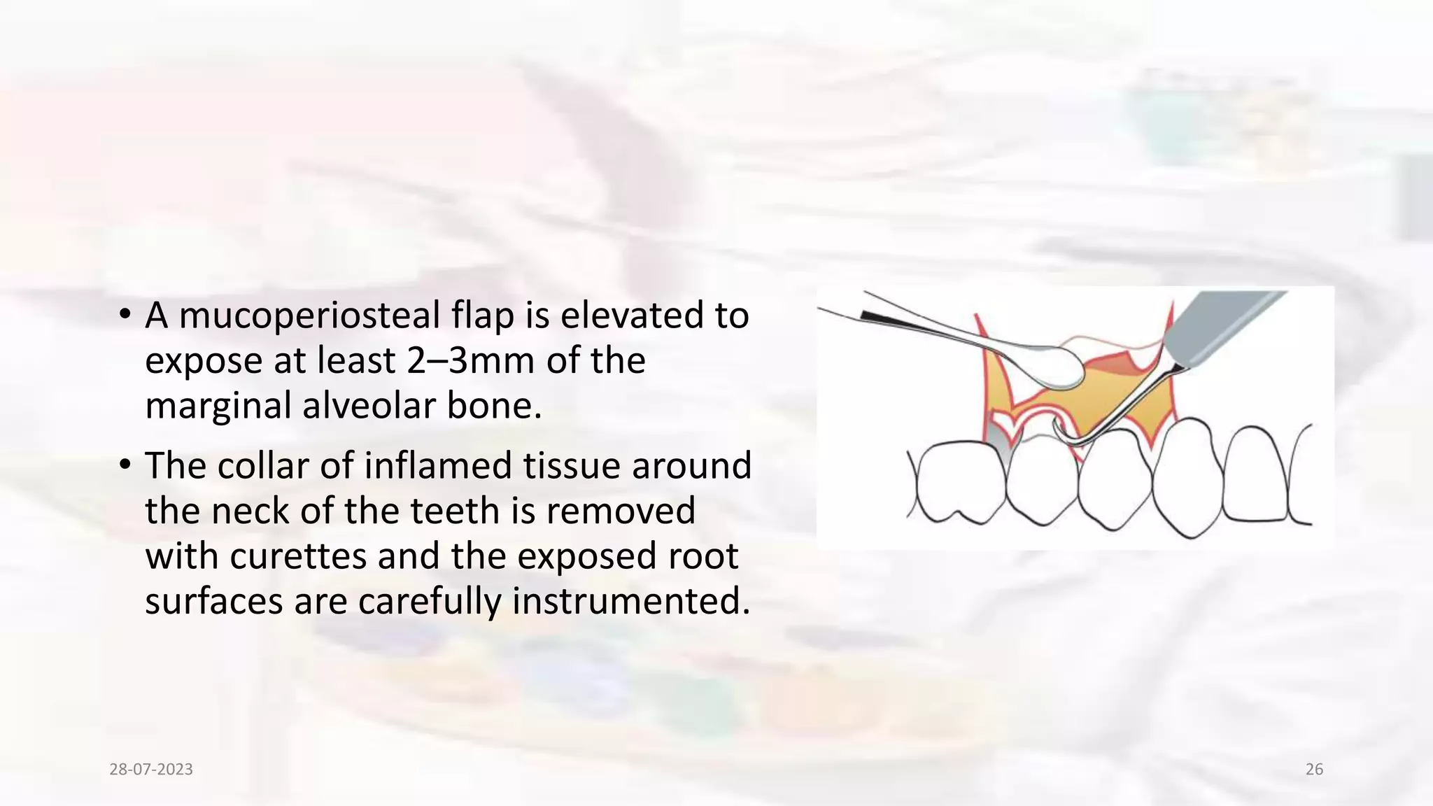 periodontal flap surgery | PPTX