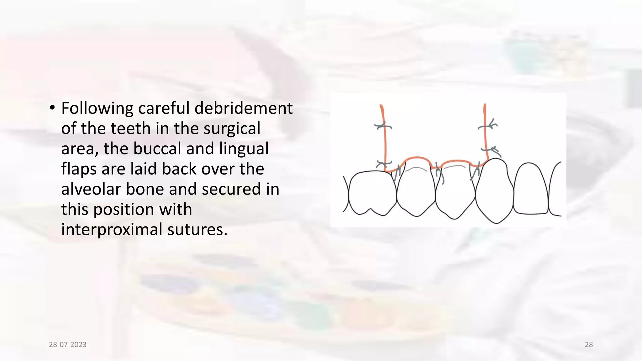 periodontal flap surgery | PPTX