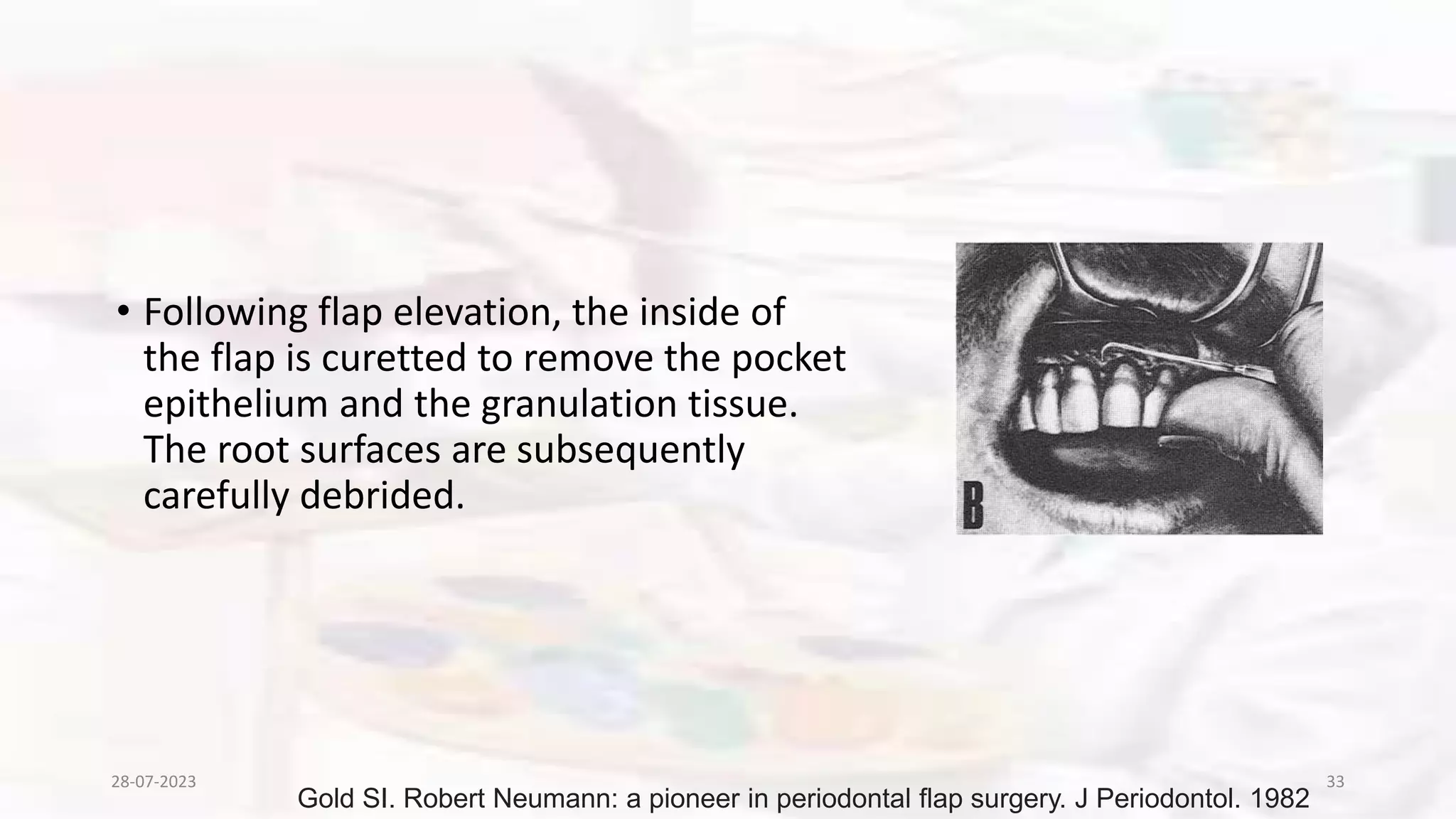 periodontal flap surgery | PPTX