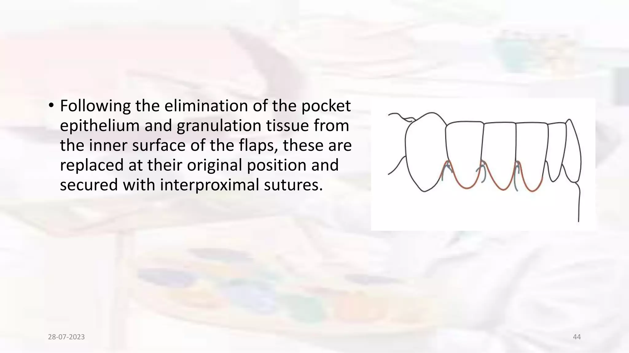 periodontal flap surgery | PPTX