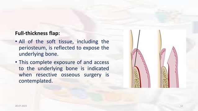 periodontal flap surgery | PPTX