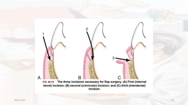 periodontal flap surgery | PPTX