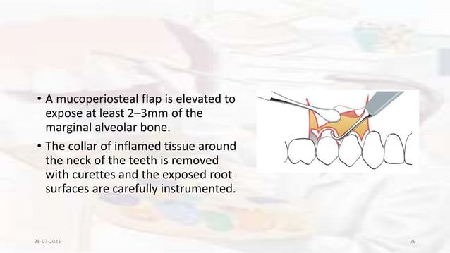 periodontal flap surgery | PPTX
