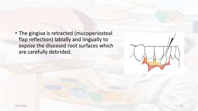 periodontal flap surgery | PPTX