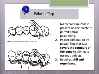 Periodontal Flap Surgery_060425.ppt