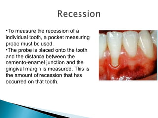 Periodontal indices and dental imaging | PPT