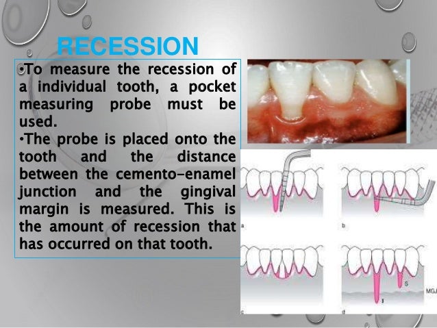 Periodontal indices final