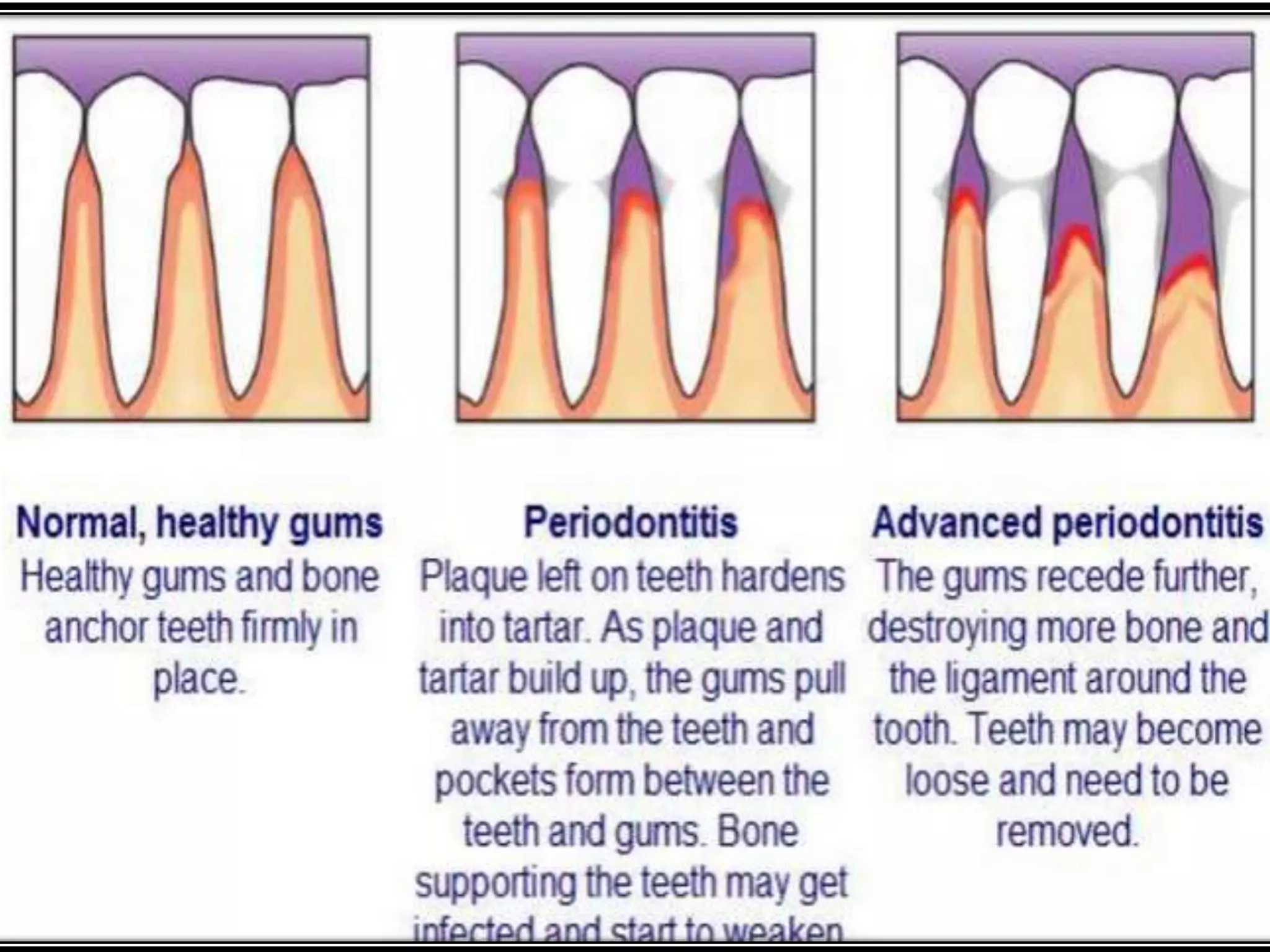 Periodontal infections | PPTX