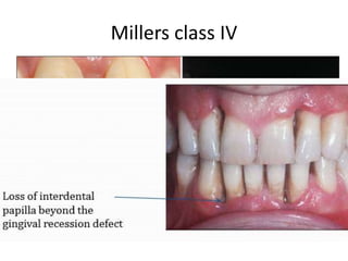 Periodontal infections | PPT