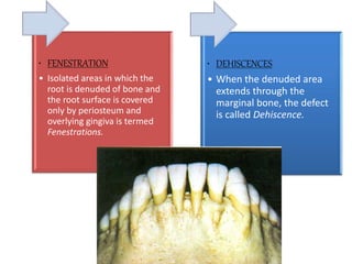 Interseptal Bone