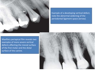 Periodontal infections | PPT