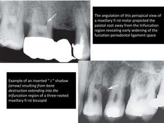 Periodontal infections | PPT