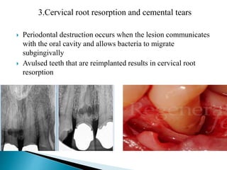 Periodontal ligament in disease | PPTX