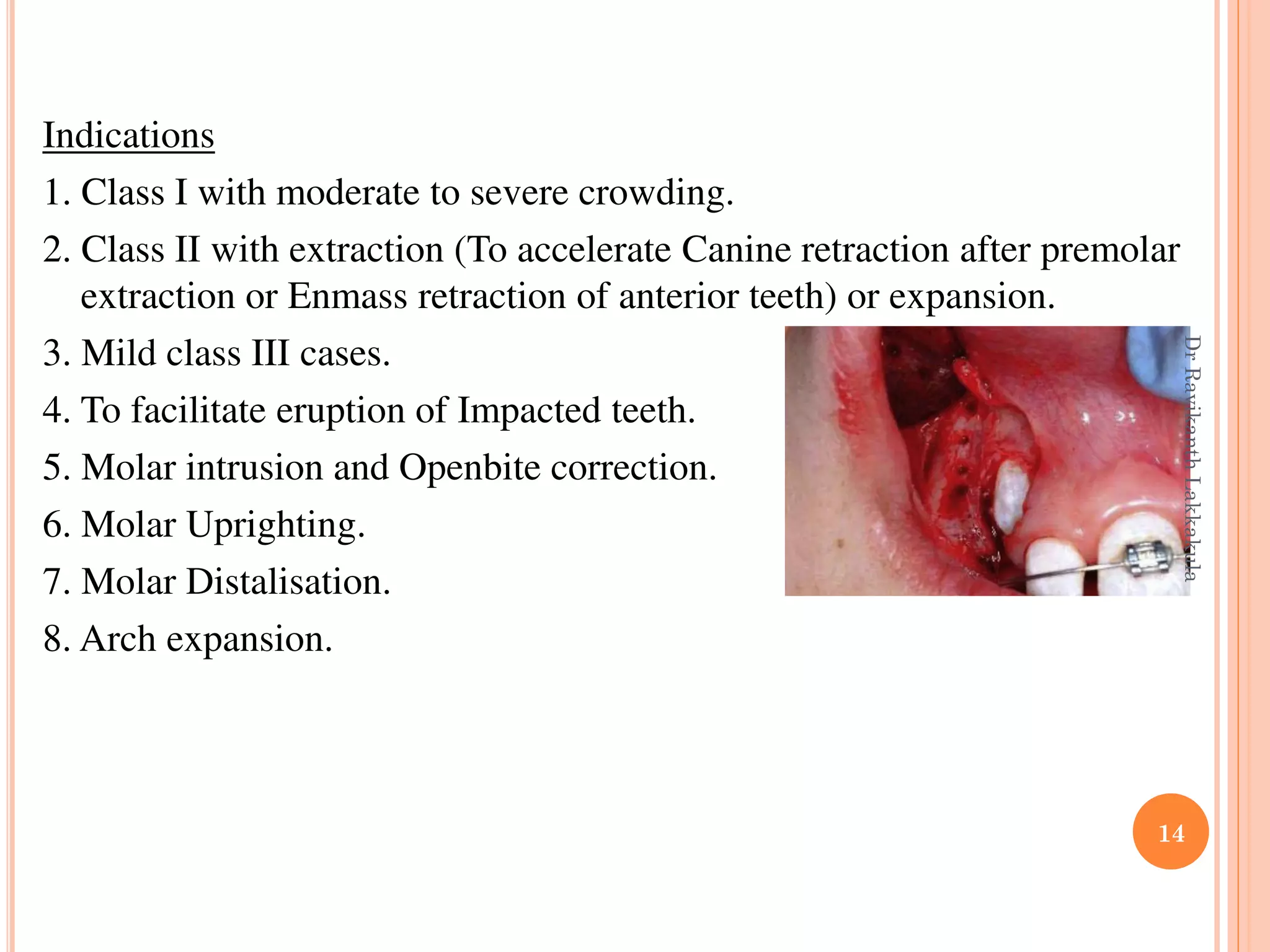 Periodontally accelerated osteogenic osthodontics | PDF