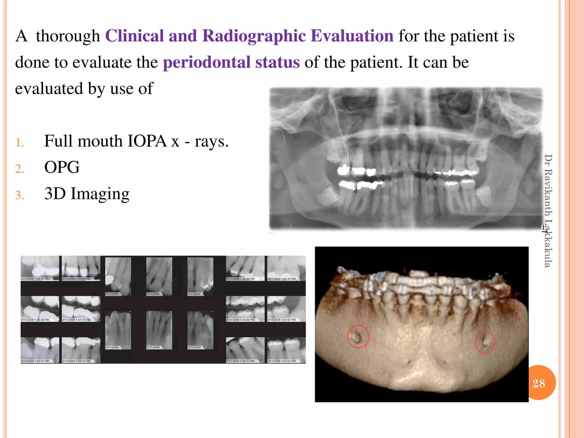 Periodontally accelerated osteogenic osthodontics | PDF
