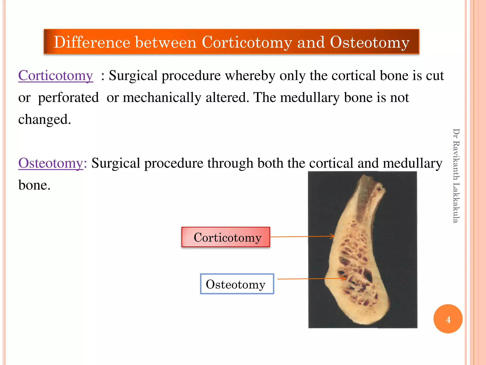 Periodontally accelerated osteogenic osthodontics | PDF