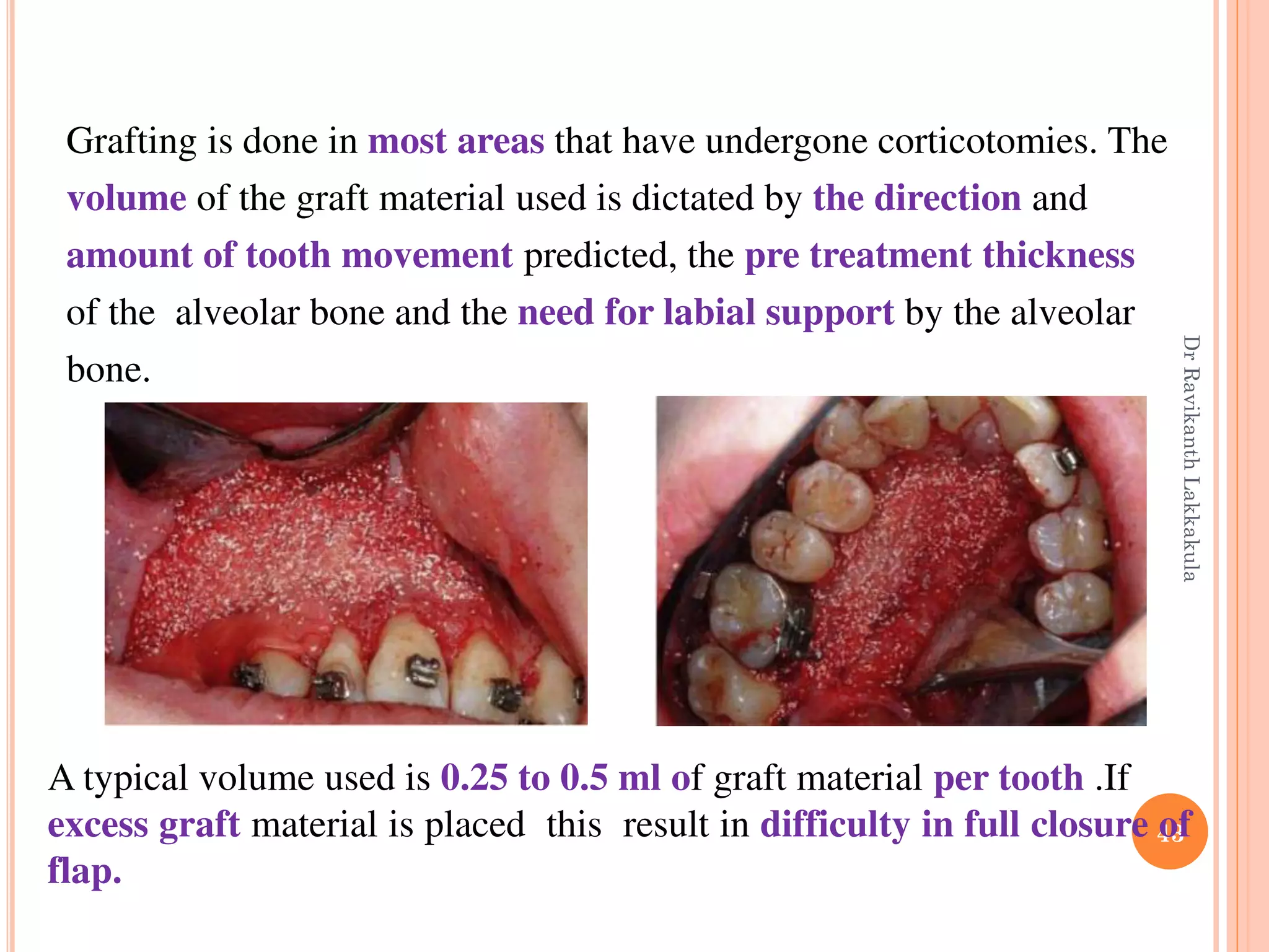 Periodontally accelerated osteogenic osthodontics | PDF