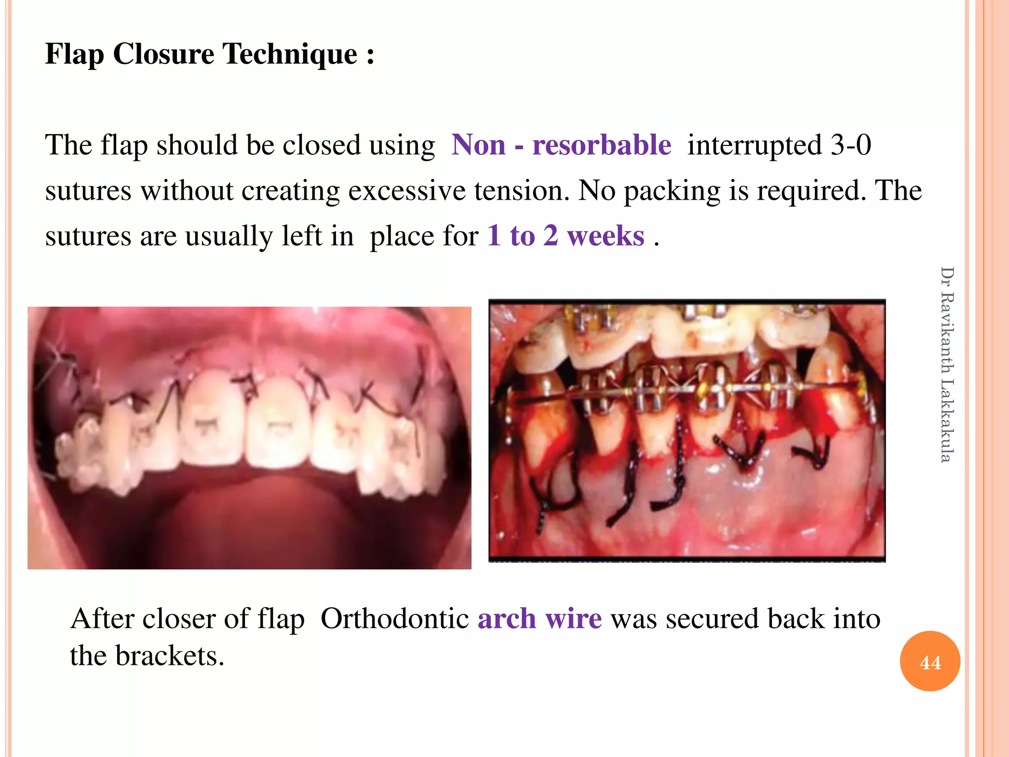 Periodontally accelerated osteogenic osthodontics | PDF