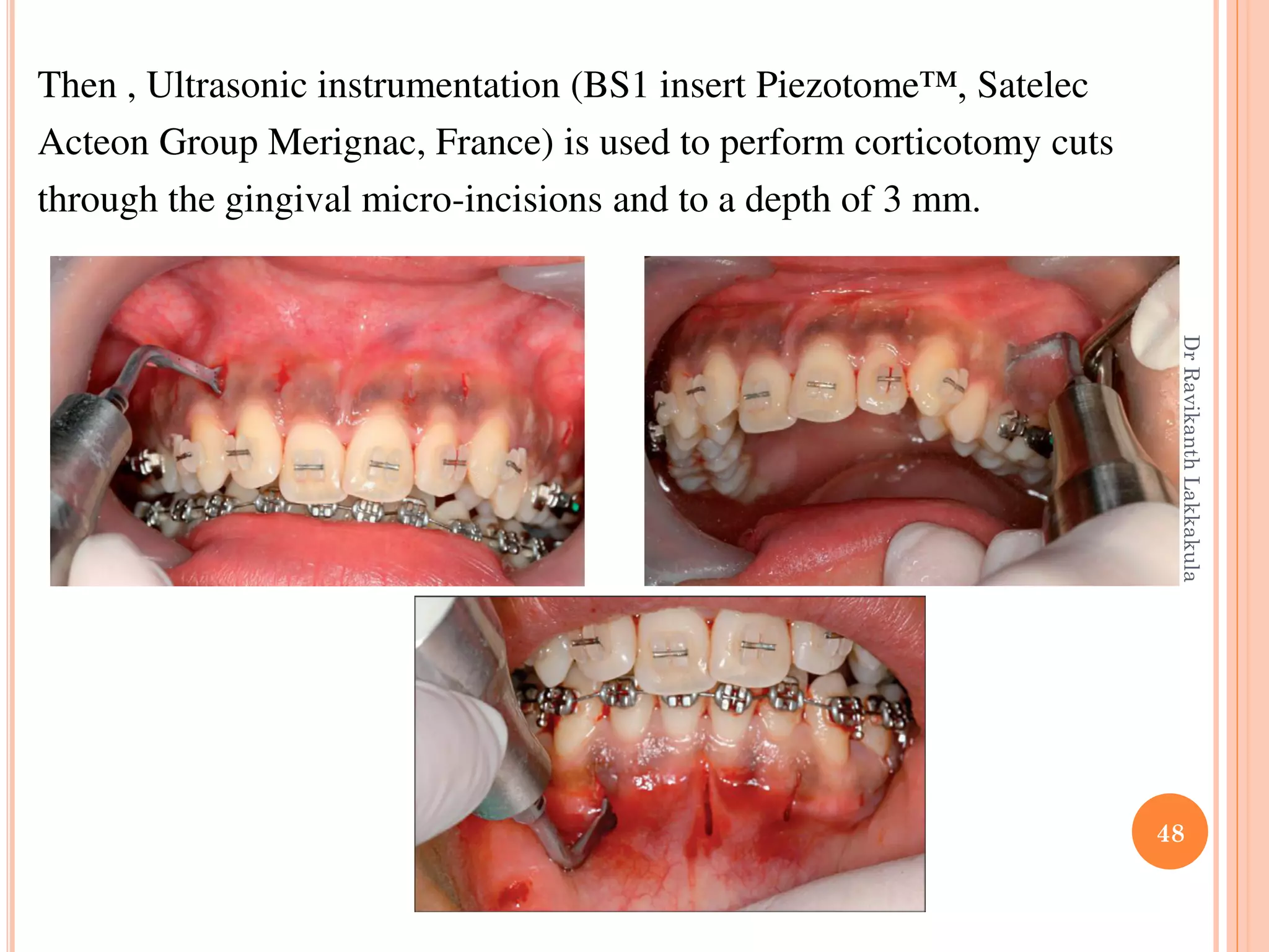 Periodontally accelerated osteogenic osthodontics | PDF
