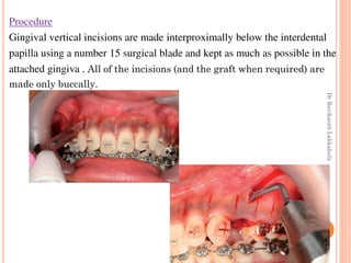 Periodontally accelerated osteogenic osthodontics | PDF