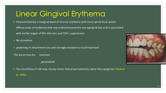 Periodontal Management Of Hiv Patients