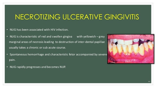 Periodontal management of HIV patients