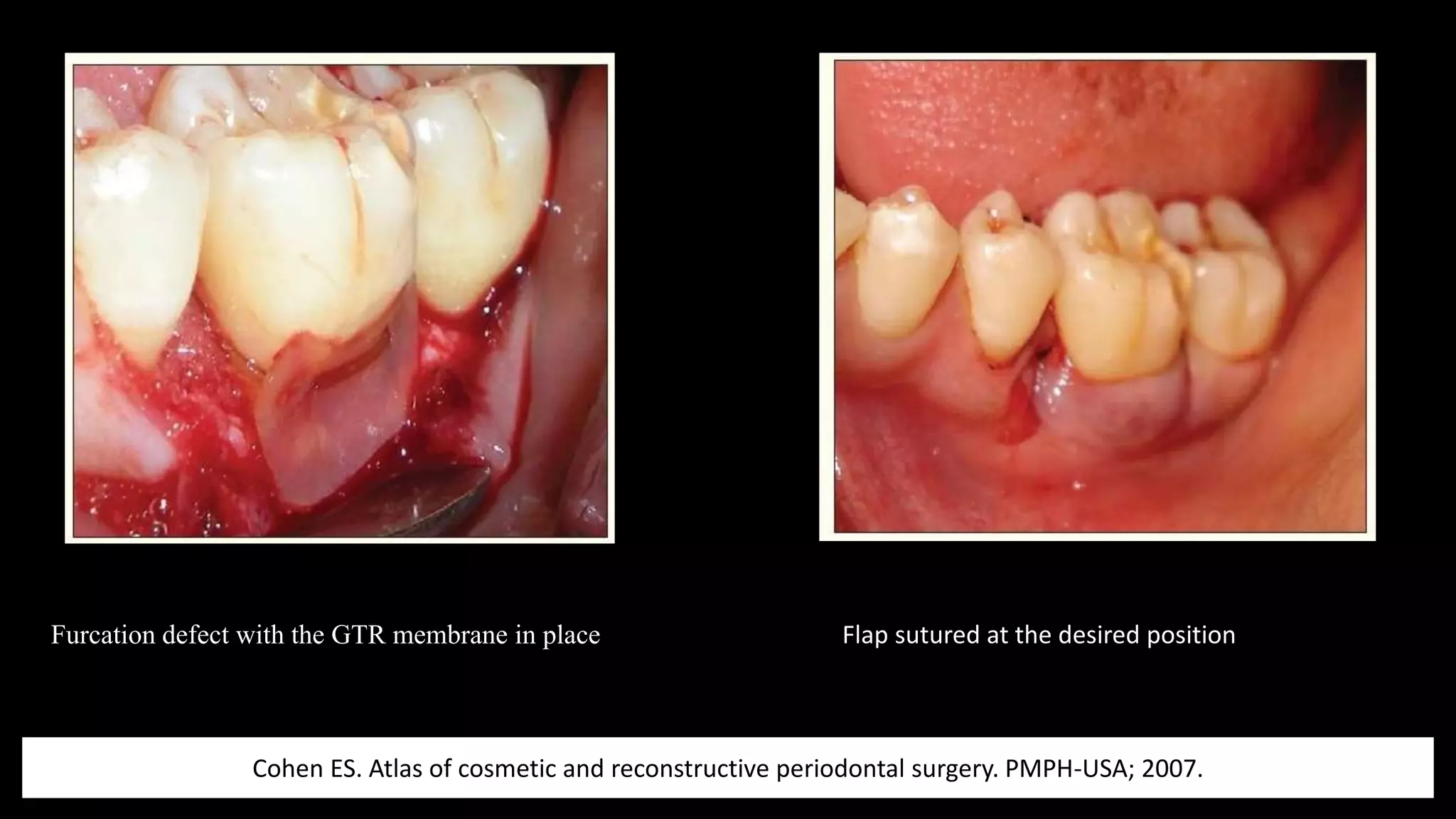Periodontal membranes – part 2 | PPTX