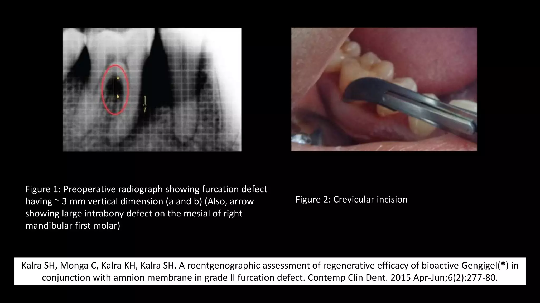 Periodontal membranes – part 2 | PPTX