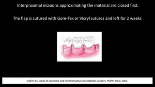 Periodontal membranes – part 2 | PPTX