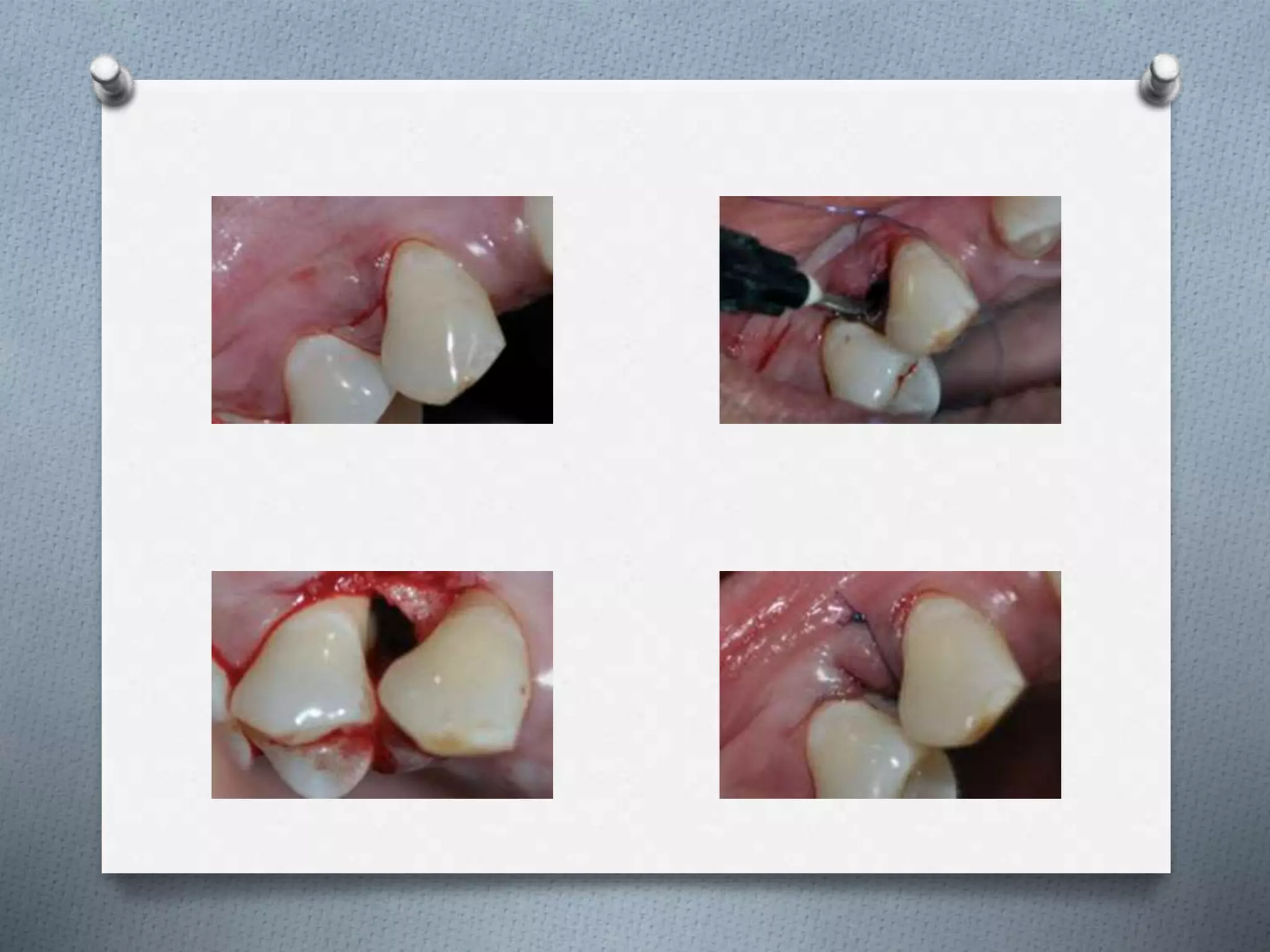 Periodontal microsurgery | PPTX