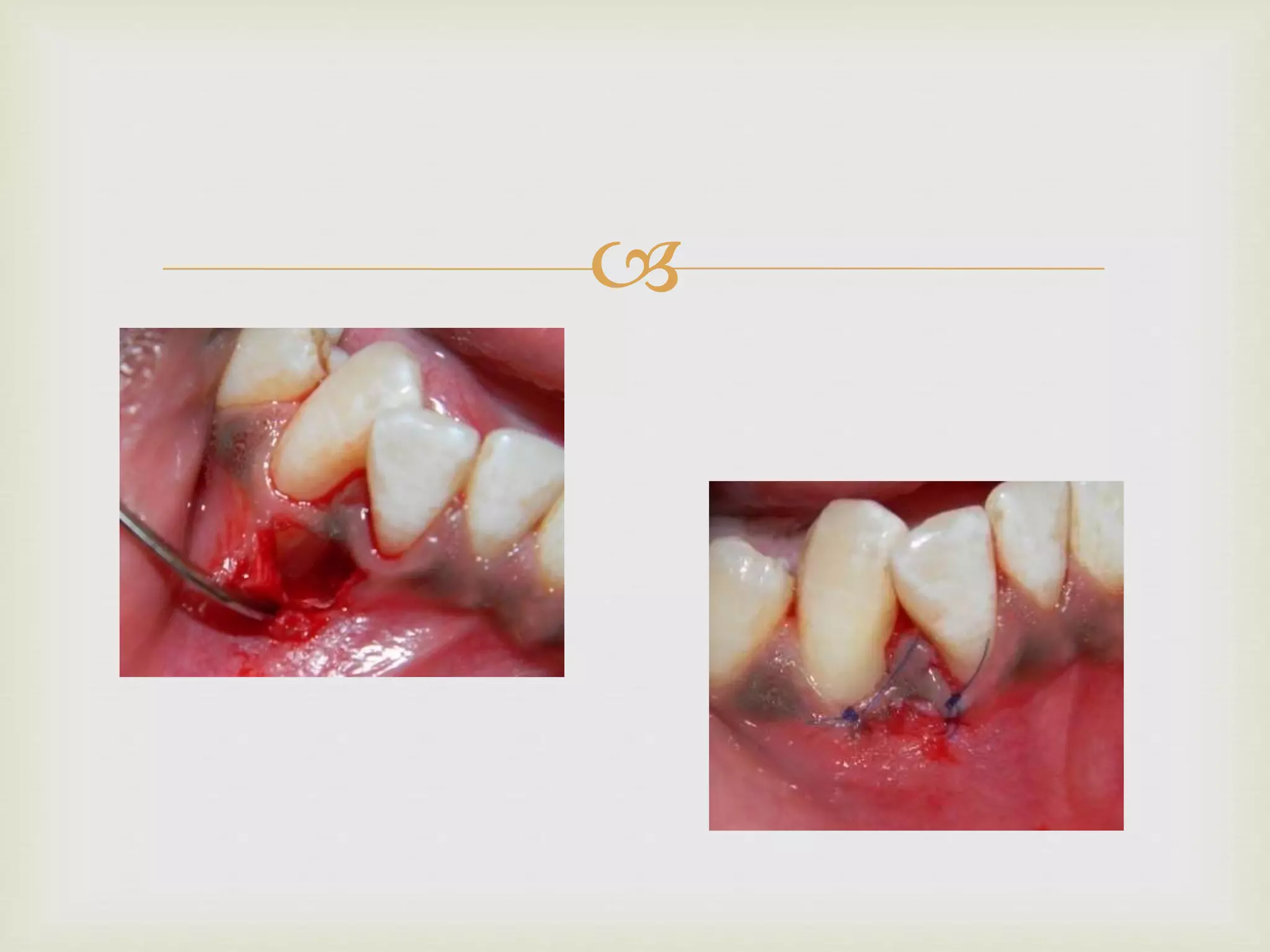 Periodontal microsurgery | PPTX
