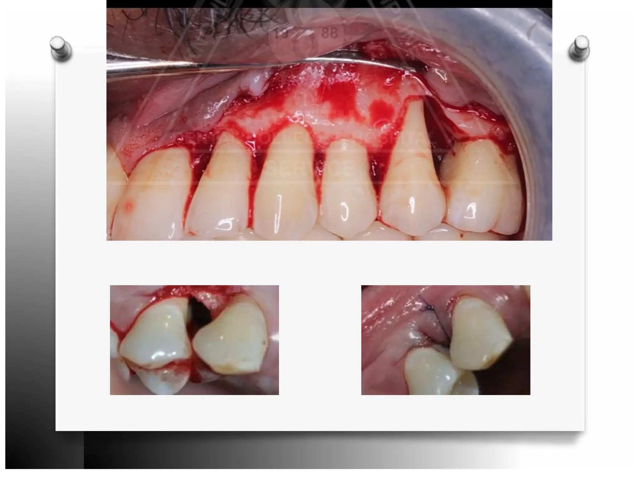 periodontal microsurgery (loupes, microscope).pptx