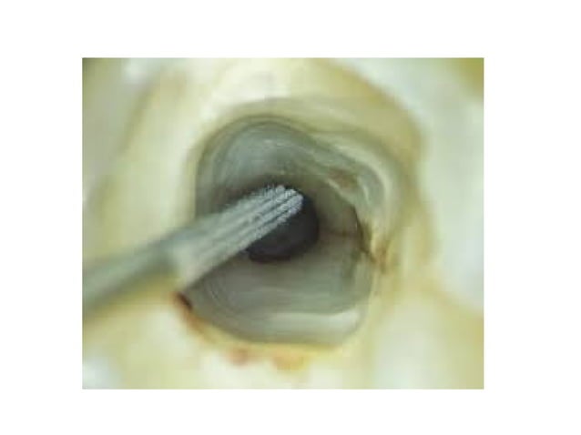 periodontal microsurgery (loupes, microscope).pptx